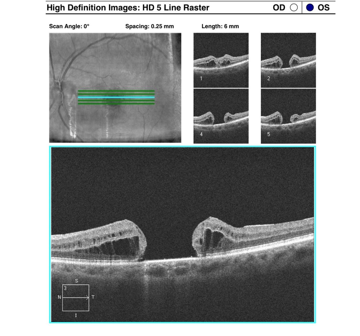Cirrus OCT - Liva Eye Center